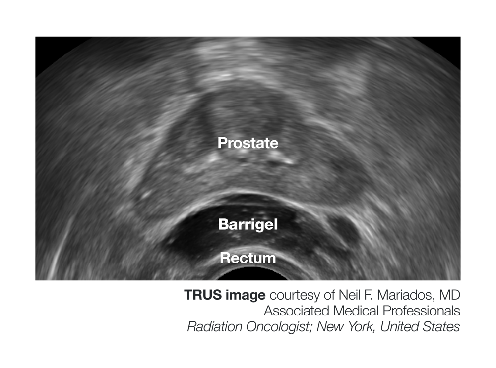 Barrigel® Rectal Spacing