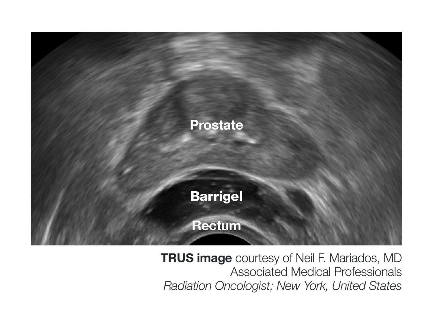 Barrigel® Rectal Spacing