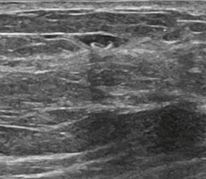 Tumark® Breast Biopsy Markers