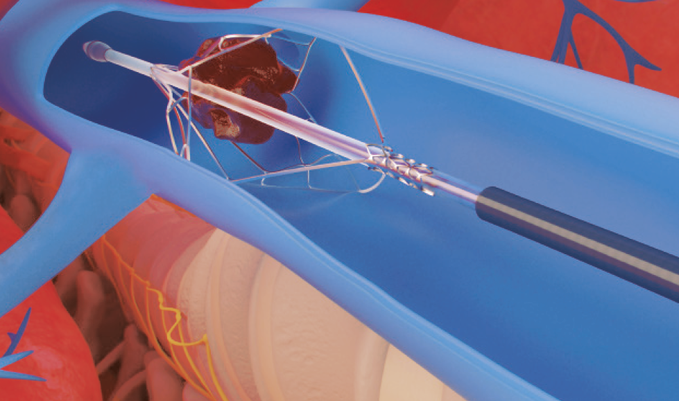 Mermaid Medical's Angel® Catheter Wins Premier Breakthrough Innovation ...