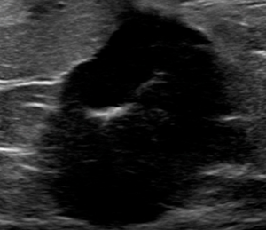 Tumark® Breast Biopsy Markers