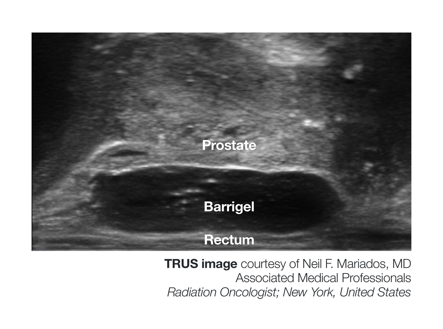 Barrigel® Rectal Spacing
