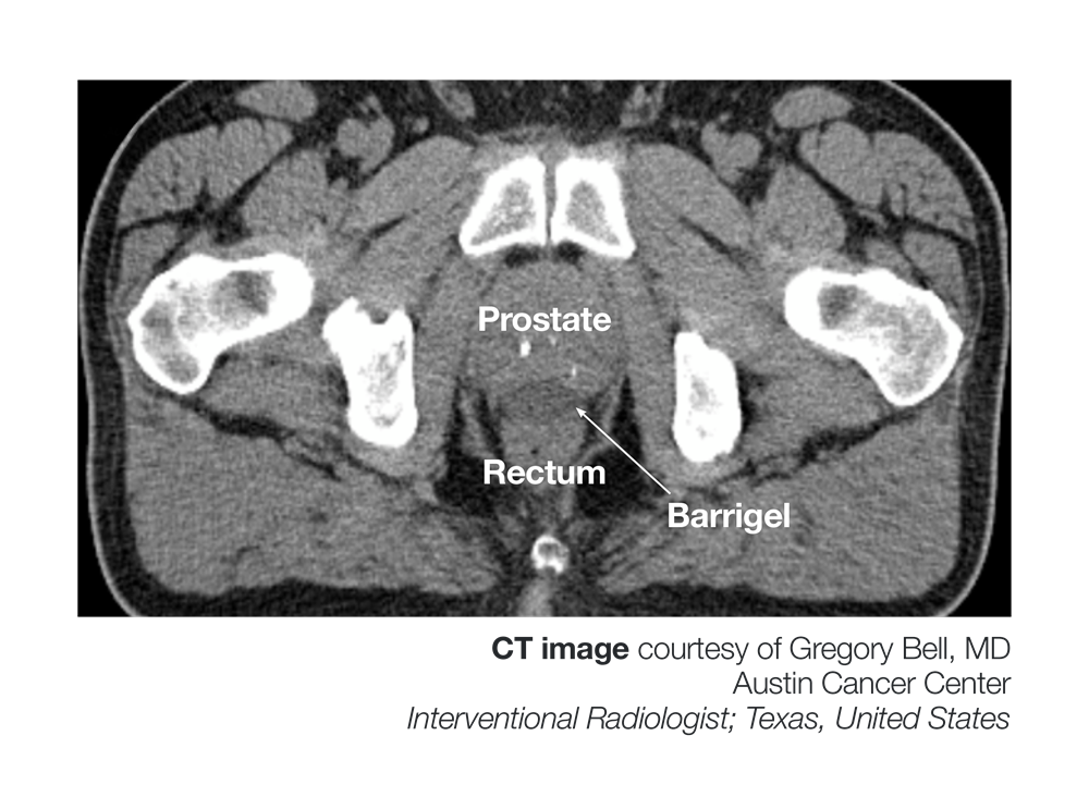 Barrigel® Rectal Spacing