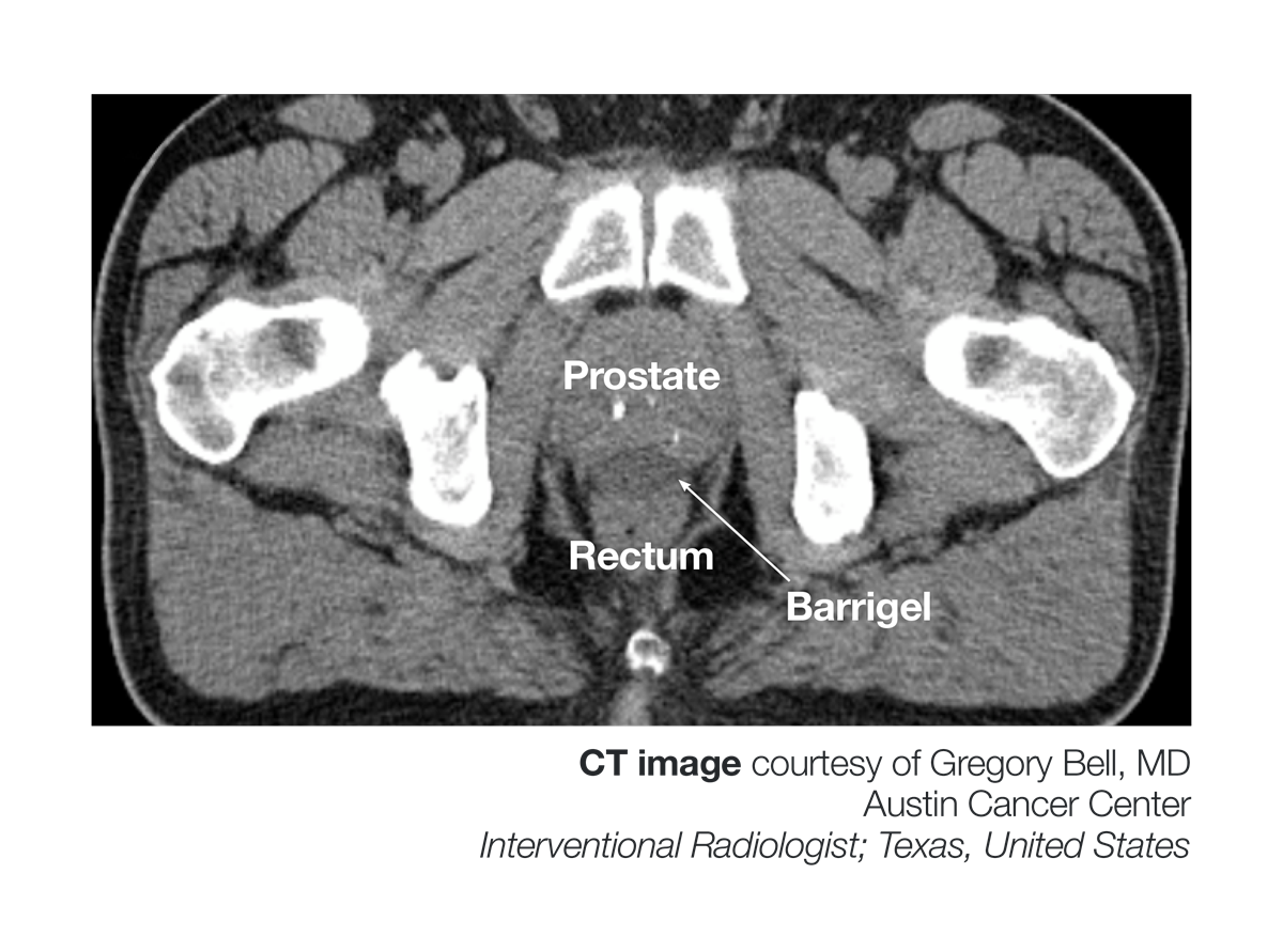Barrigel® Rectal Spacing