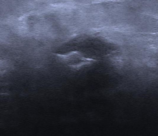 Tumark® Breast Biopsy Markers