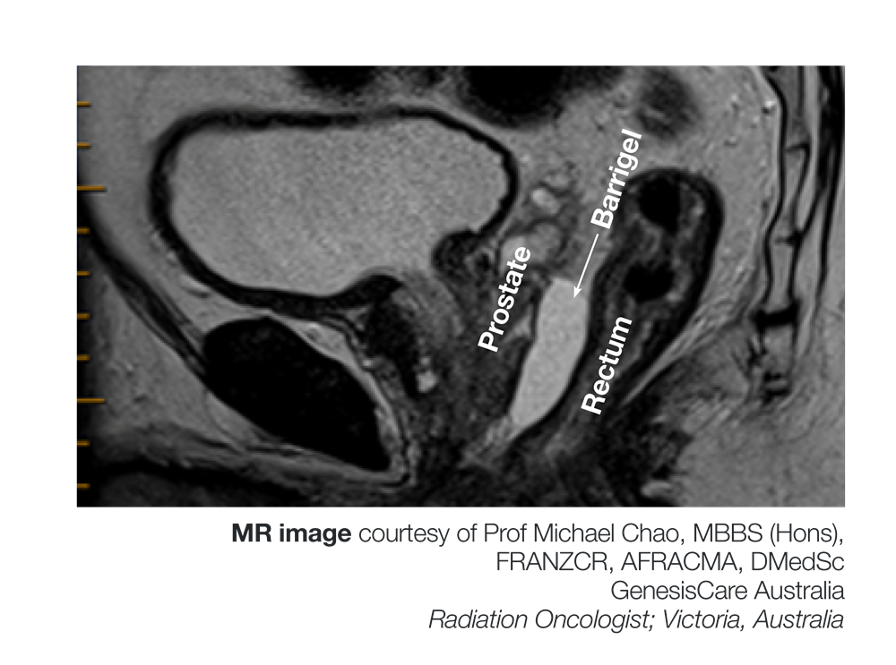 Barrigel® Rectal Spacing
