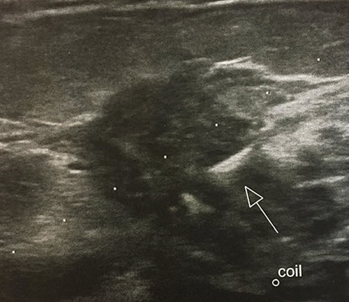 Tumark® Breast Biopsy Markers